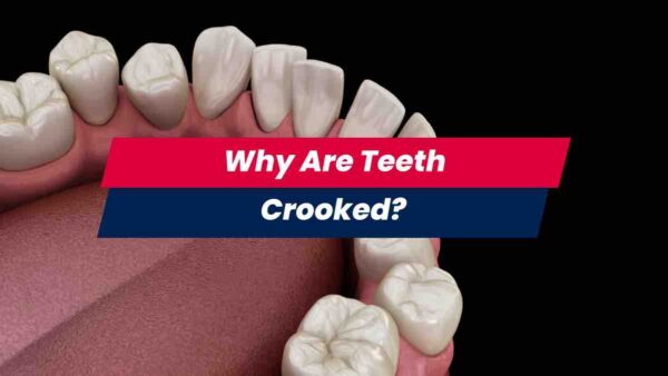 Why are Teeth Crooked and Can You Fix Them? | USHEALTH Group